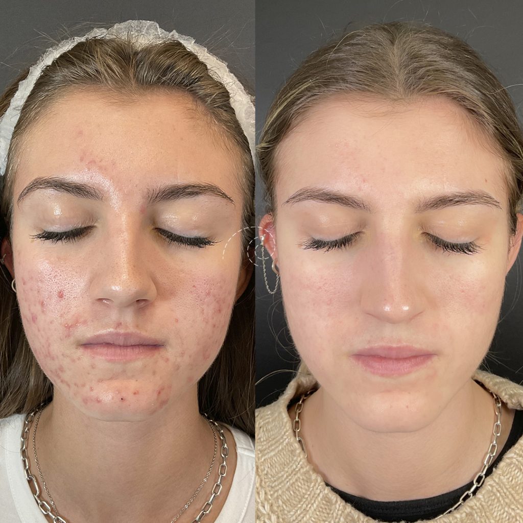 Láser y Sol: ¿es posible tratar el acné en verano? - Cliniem