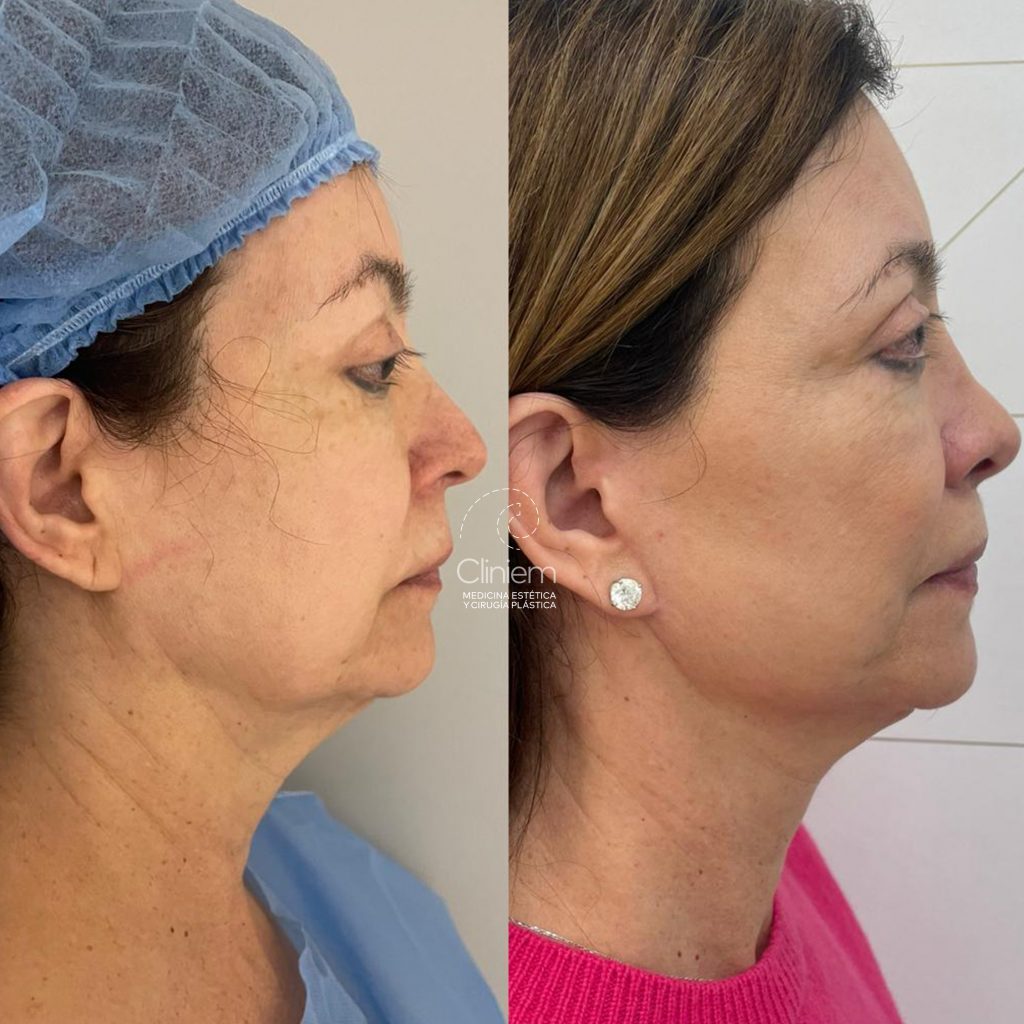¿Miedo al lifting facial completo? Prueba con el minilifting - Cliniem